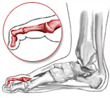 Hammer Toe Foot Ankle Orthobullets